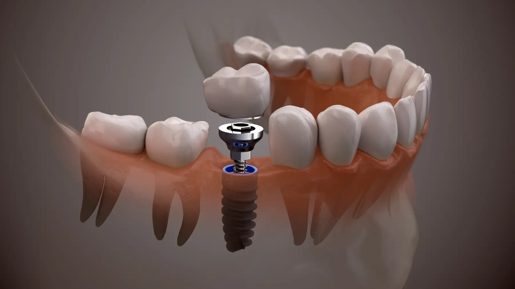 Dentures vs Dental Implants in Los Algodones: Guide